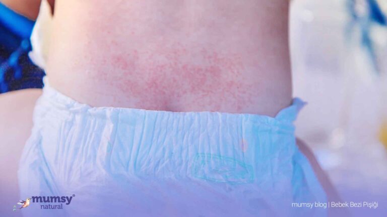 Baby Skin Rashes and Bumps: Causes, Types, and What to Do - Mumsy Natural