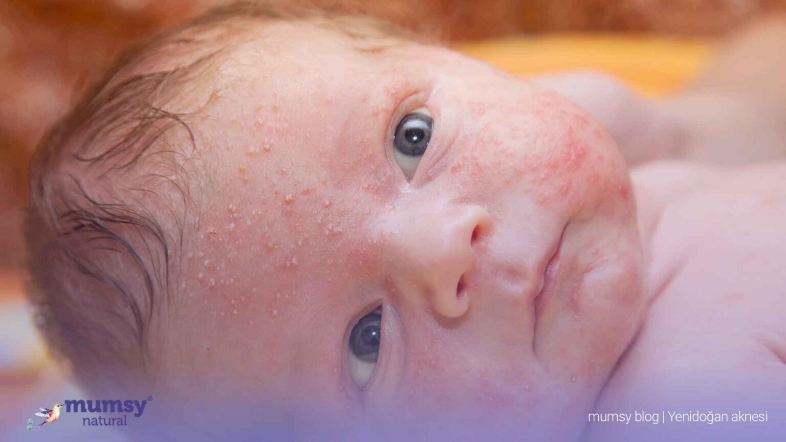 Baby Skin Rashes and Bumps: Causes, Types, and What to Do - Mumsy Natural