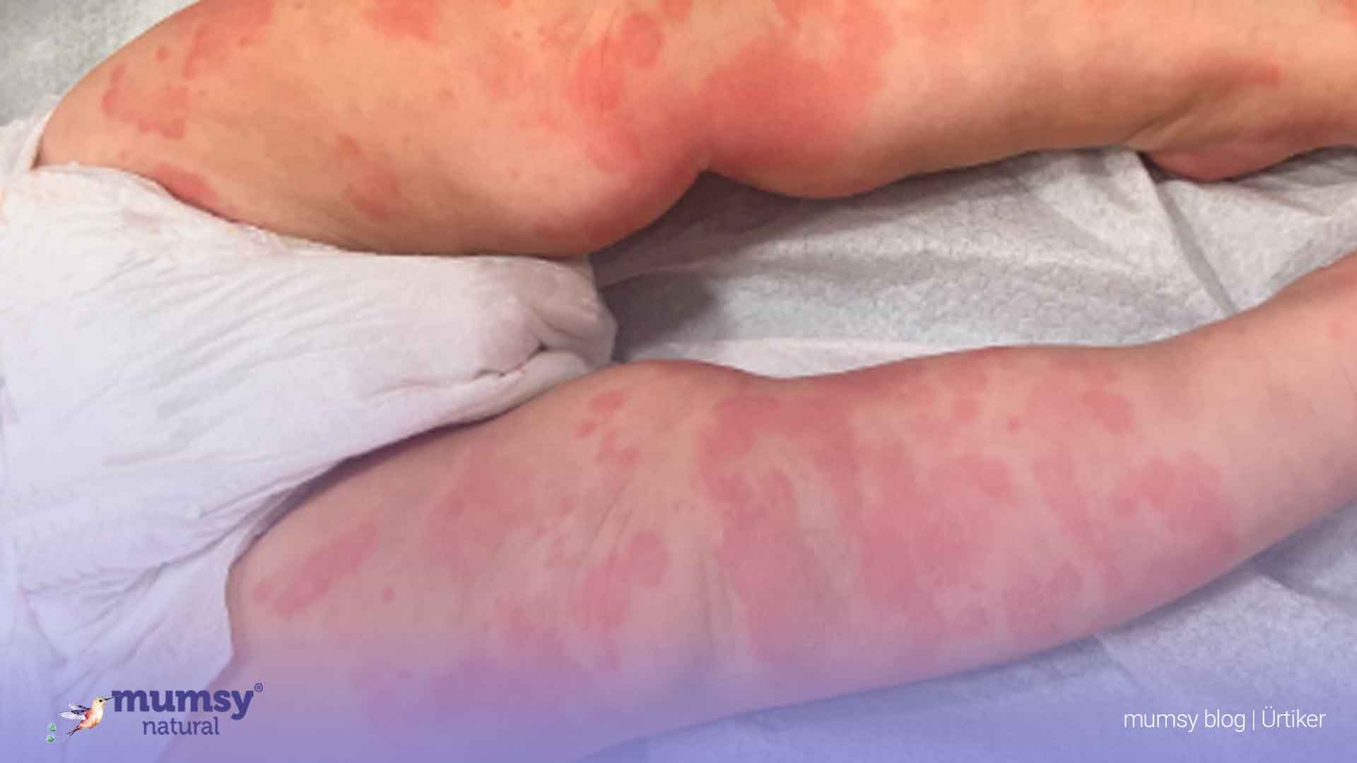 Baby Skin Rashes and Bumps: Causes, Types, and What to Do - Mumsy Natural